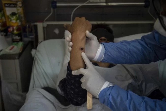 Epidemia de varíola do macaco recuou, mas não desapareceu | Diario de ...