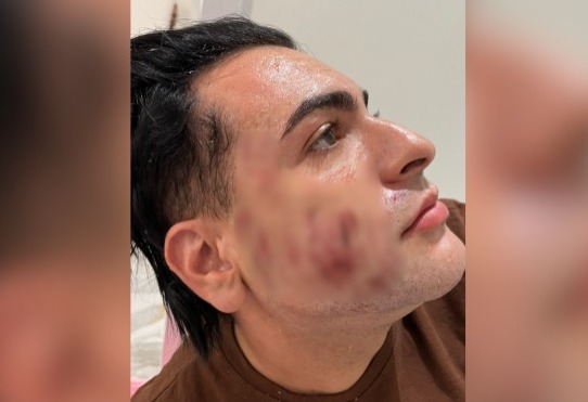 Morte após 'peeling de fenol': veja o que se sabe sobre o caso | Diario ...